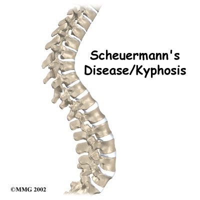 Scheuermann's Kyphosis - Q & A with Tom Myers