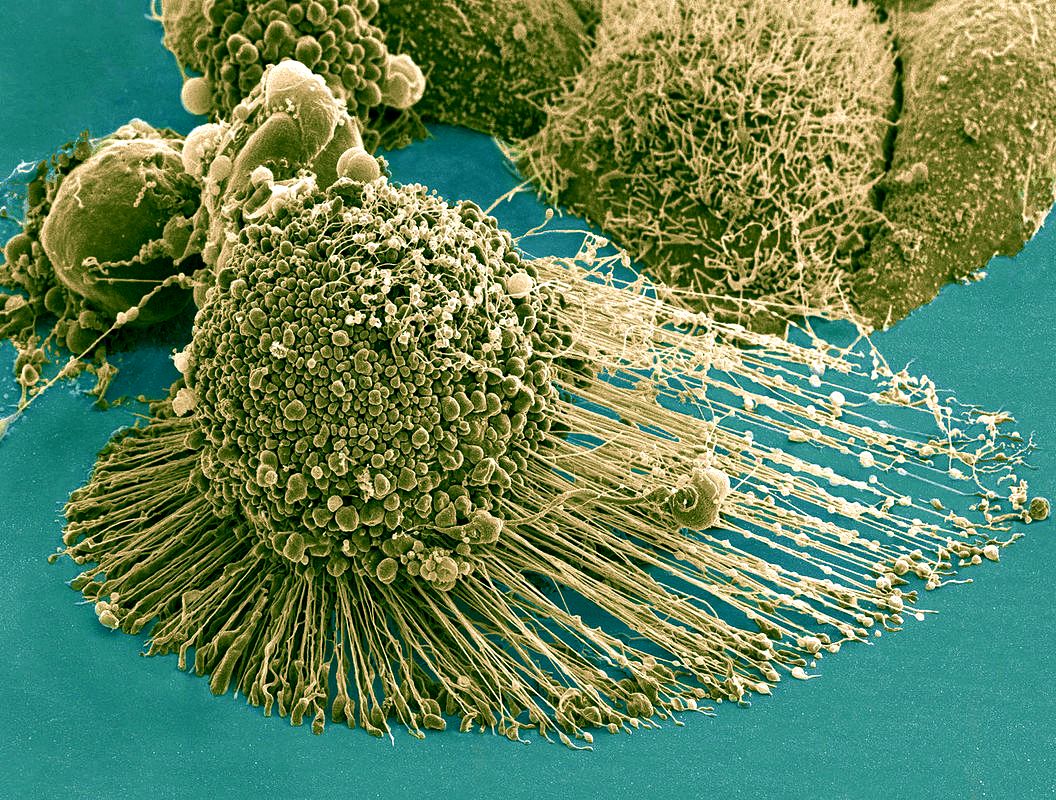 Spatial Medicine - Fascia Research and Cancer